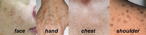 Other Services Offered Rutland Skin Center