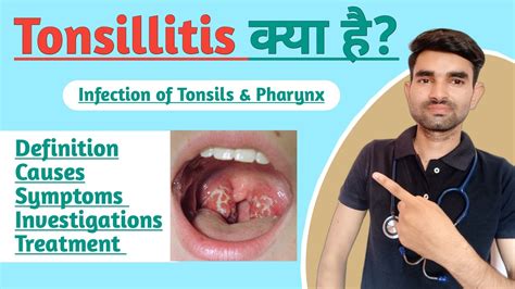 Early Tonsillitis