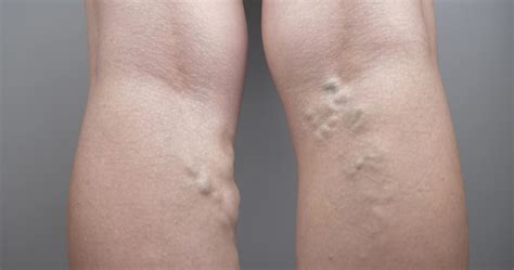 Female Varicose Legs Swollen Veins 16247778 Stock Video At Vecteezy
