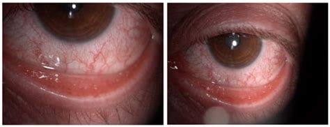 Dupilumab Associated Blepharoconjunctivitis Clinical And Morphological