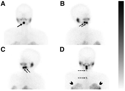 Ectopic Thyroid