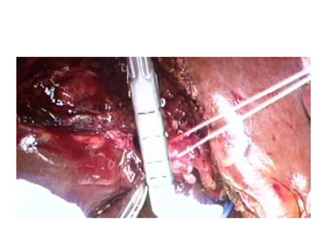 Right Hepatectomy Step By Step Description For Surgeon Pptx