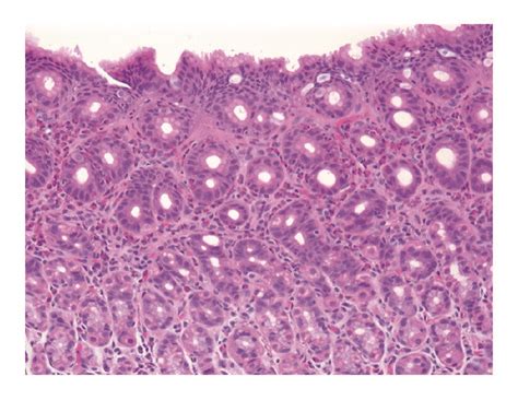 Moderate To Severe Chronic Gastritis With Focally Increased
