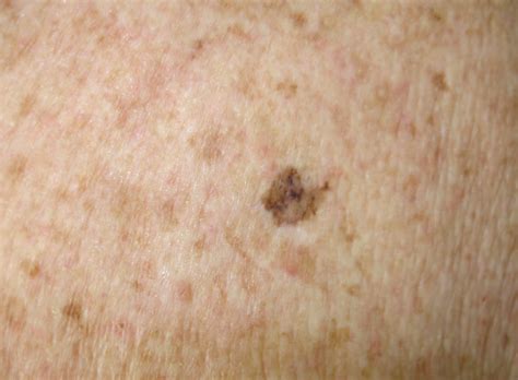 Consultations In Dermatoscopy Dysplastic Junctional Lentiginous Nevus