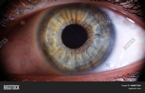 Inflamed Reddened Eye Image And Photo Free Trial Bigstock