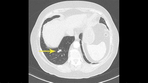 Thoracoscopic Right S10 Segmentectomy Alternative Posterior Approach Mmcts