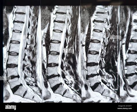 Magnetic Resonance Imaging Mri Of The Lumbosacral Spine Shows