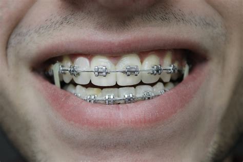What Impact Do Braces Have On Facial Structure Burke And Beckstrom