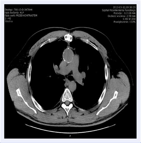 Resolution Of Periaortic Mass On Repeated Computer Tomography Scan