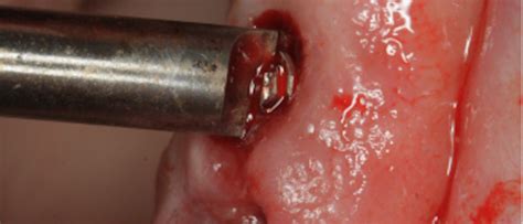 How To Use A Dental Implant Verification Jig To Ensure An Accurate Final Framework Every Time