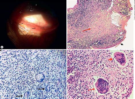 Figure 1 From Primary Conjunctival Tuberculosis Presenting As Dry Eye A Rare Case Report And