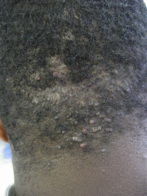 Folliculitis Keloidalis Nuchae And Pseudofolliculitis Barbae