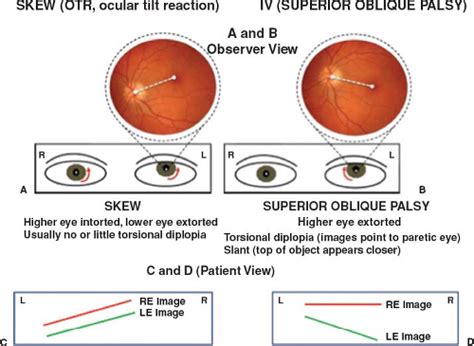 Supranuclear And Internuclear Ocular Motor Disorders Ento Key