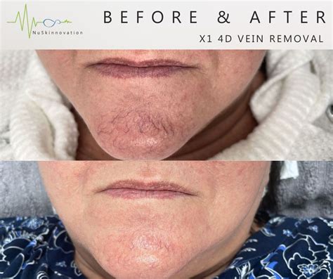 Laser Treatment For Telangiectasis Nuskinnovation Pty Ltd Laser Skin Clinic