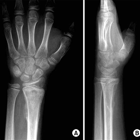 Pdf Simple Subperiosteal Hematoma With A Periosteal Reaction