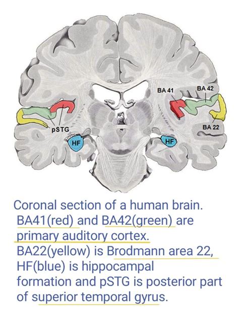 Primary Auditory Cortex Neurology Cns Human Brain
