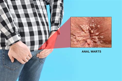 Anal Warts Ghodke Piles Hospital In Beed Maharashtra