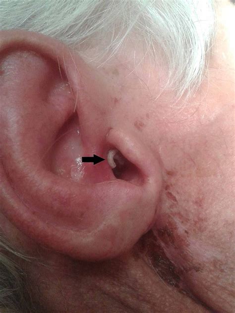 Understanding Aural Myiasis Symptoms Causes And Treatment The Dreamer