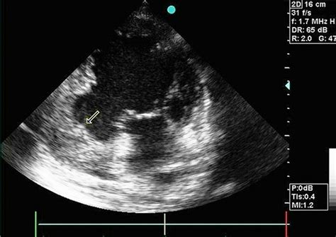 Rare Case Of Large Basal Inferior Wall Aneurysm