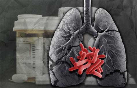 Tuberculosis Resistente Al Tratamiento Ciencia Uanl