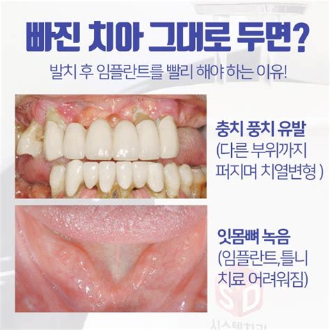 어금니 발치 해야 하는 경우 치료법 네이버 블로그