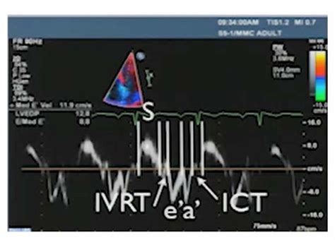 Diastolic Dysfunction Flashcards Quizlet