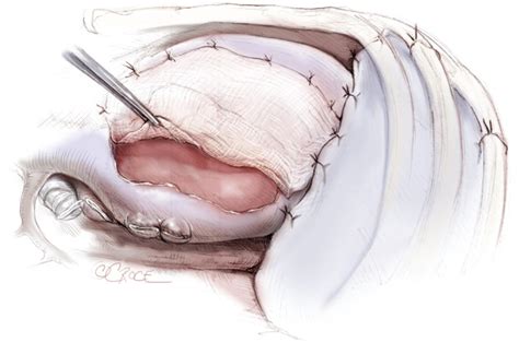 Extrapleural Pneumonectomy And Extended Pleurectomydecortication For