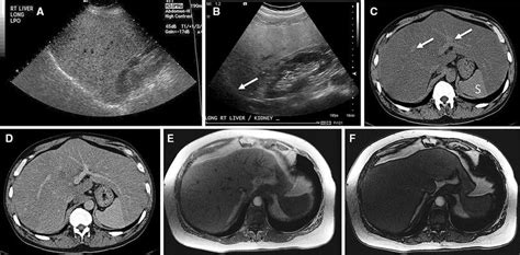 Mild Fatty Infiltration Of The Liver Means Fatty Liver Disease Bgfcid