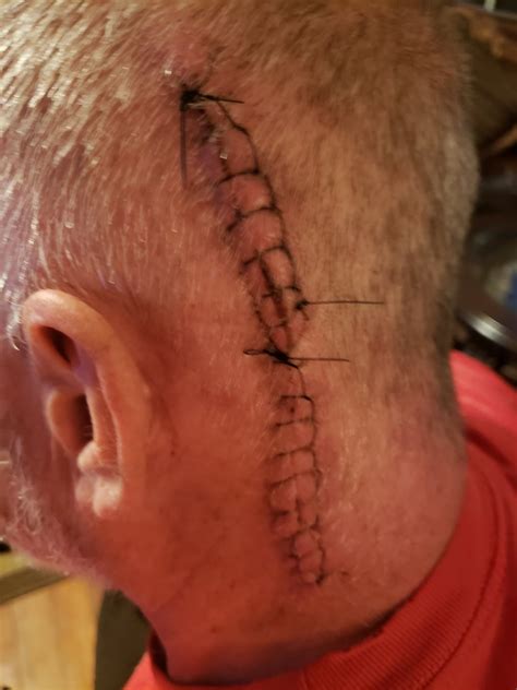 Anyone Have Occipital Neuralgia With Trigeminal Neuralgia My