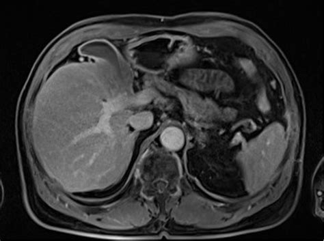 Primary Mucosa Associated Lymphoid Tissue Lymphoma Of The Gallbladder