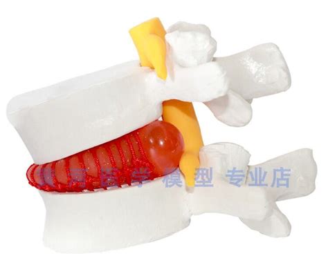 ขายร้อน Lumbar Spine รุ่น Human Body Lumbar Intervertebral Disc สาธิต