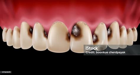 Tooth Decay And Calculus On Teeth Stock Illustration Download Image