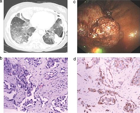Primary Pulmonary Angiosarcoma Three Case Reports And Literature