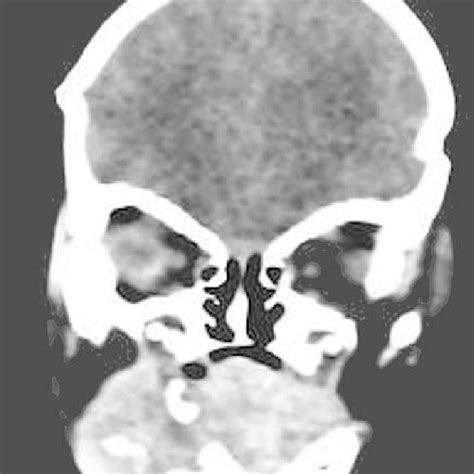 Ct Scan Demonstrated The Expansile Mass Lesion With Hypoattenuating