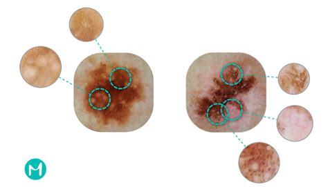 Molescope™ Order Vs Chaos Evolution Of Pattern Analysis In Dermoscopy