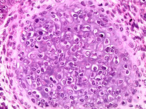 Testicular Teratoma Ultrasound