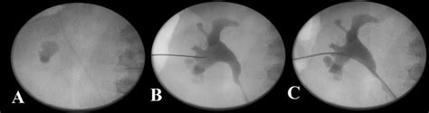 A Treatment Strategy In Case Of A Stone In The Lower Pole B System Is
