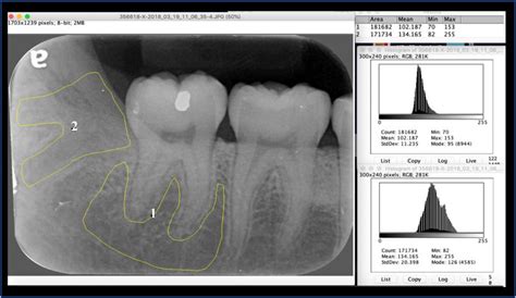 Histogram Analysis Using Image J 152a 1 An Area Of Basal Bone And