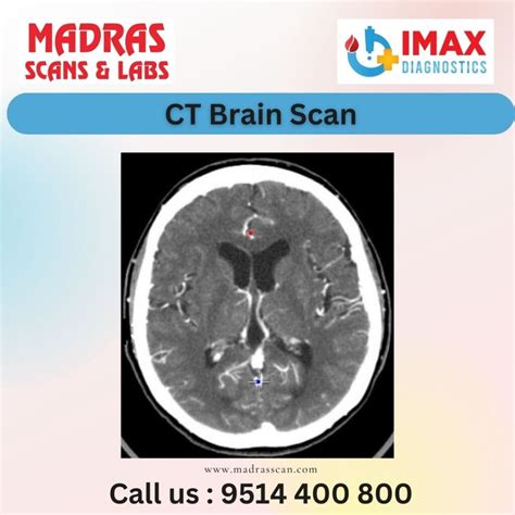 Ct Brain Scan In Chennai Madras Scans