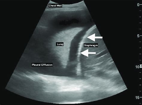 Convex Probe Consolidated Lung Surrounded By Hypoechoic Pleural