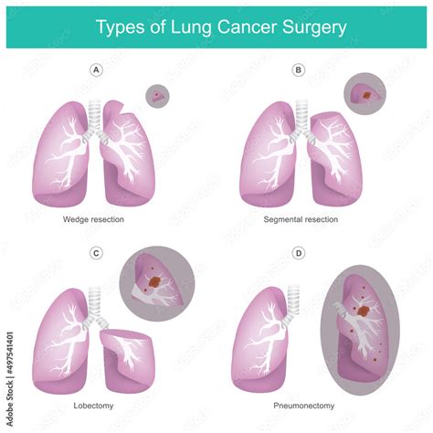Types Of Lung Cancer Surgery Illustration The Lung 4 Types Surgery