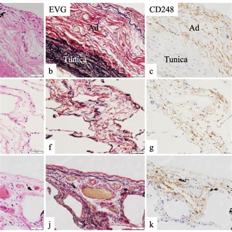 Serial Tissue Sections Of Ipf Lungs Cases 1 3 Were Stained With A Download Scientific