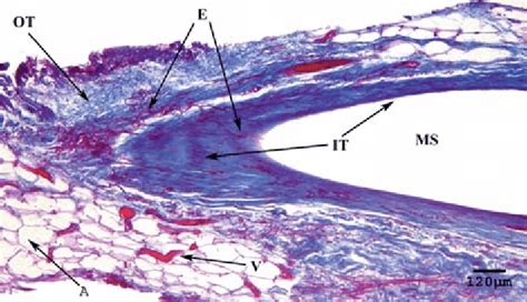 Monofilament Suture From Masseteric Region Gomori Trichrome Stain