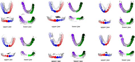 Teeth3ds A Benchmark For Teeth Segmentation And Labeling From Intra