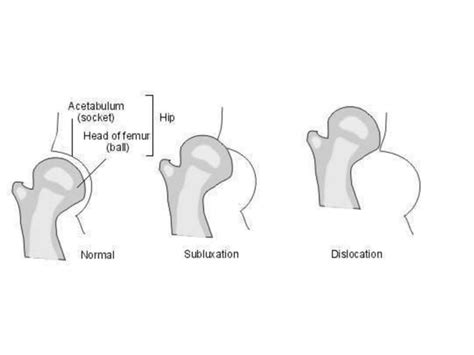Developmental Dysplasia Of Hip Ddh Pptx Pregnancy Reproductive Health