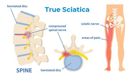 Sciatic Nerve Entrapment A Real Pain In The Butt