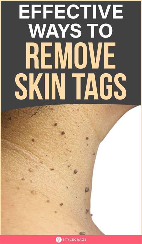 12 Incredible Home Remedies To Remove Skin Tags Nqqa