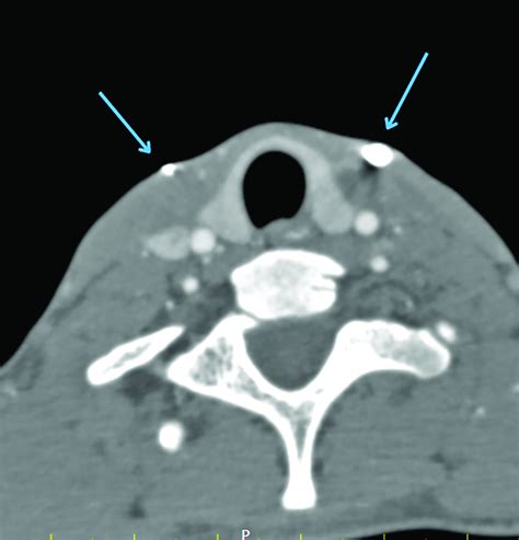 Bilateral Branchial Cleft Fistulae Applied Radiology