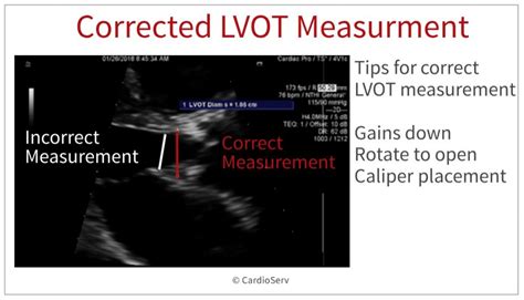 Aortic Stenosis And Mismatch Values Cardioserv