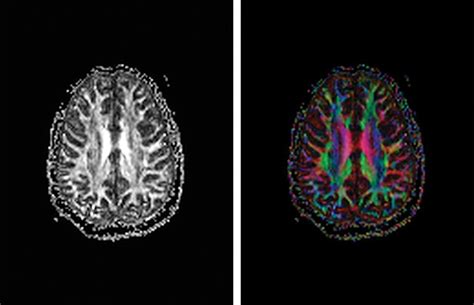 Diffusion Tensor Imaging